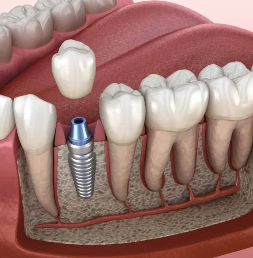 Dental Bone Grafting in Noblesville, IN | Restore Your Smile
