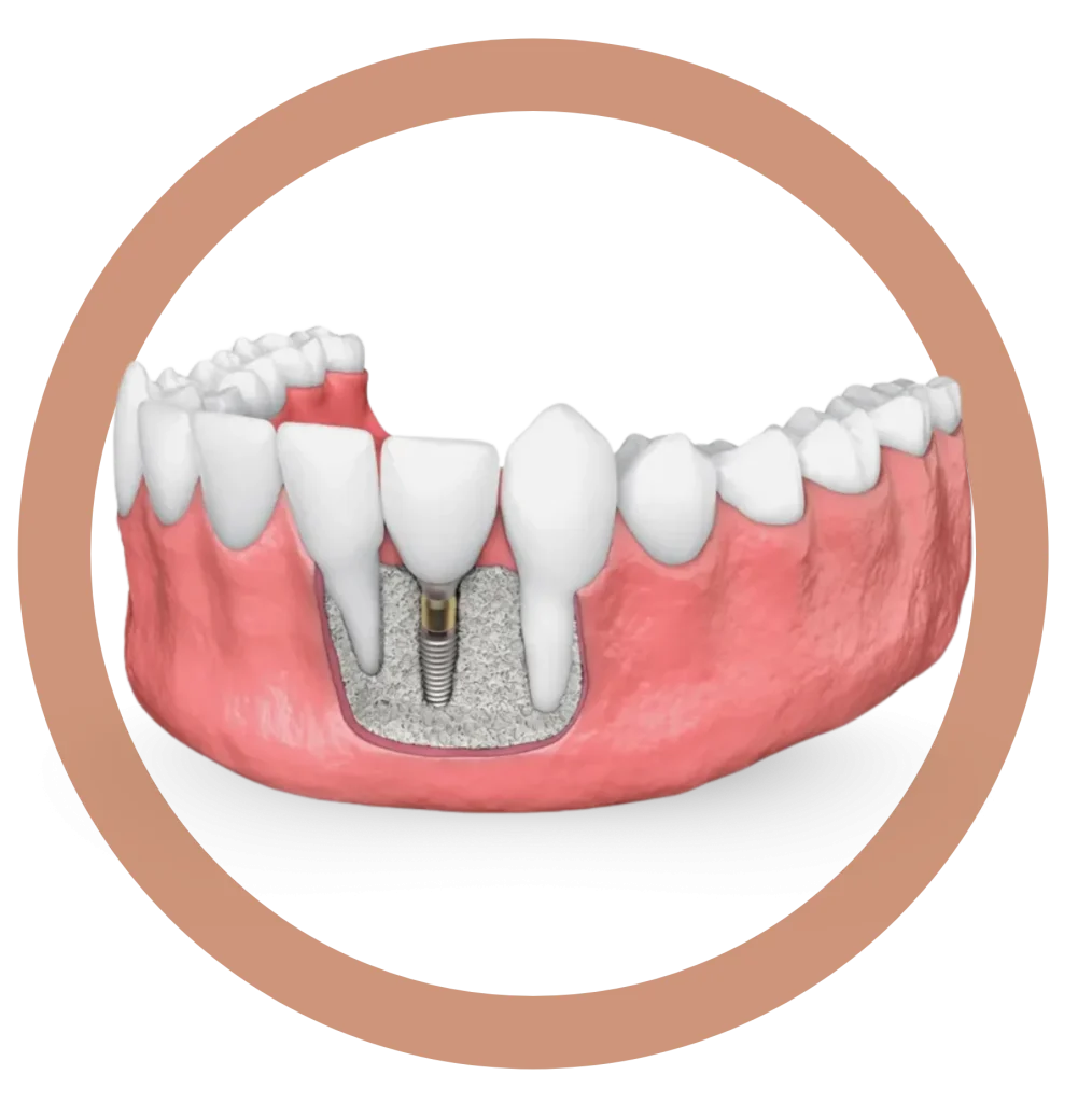 Dental Bone Grafting in Noblesville, IN | Restore Your Smile