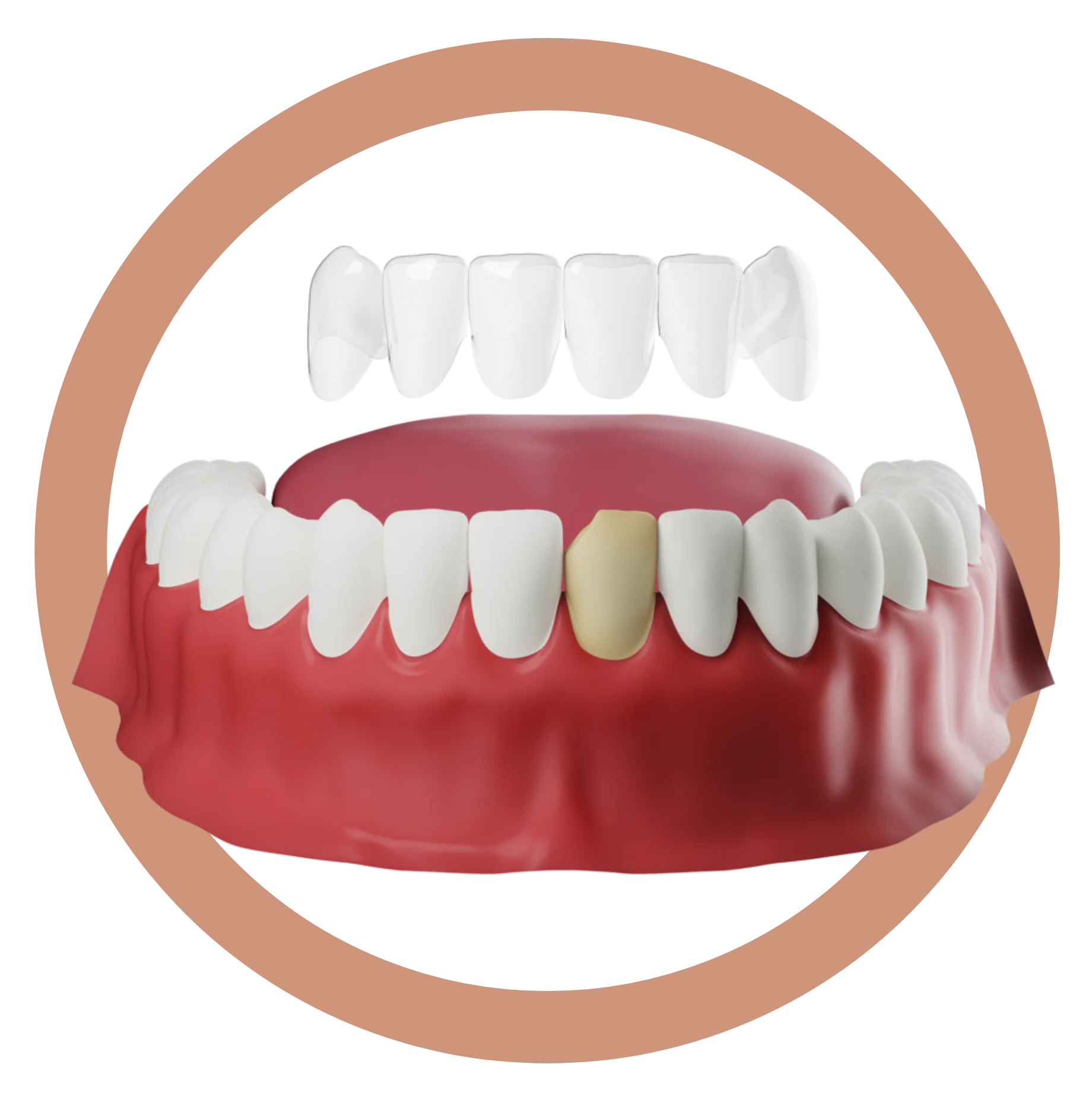 Dental Veneers Noblesville | Custom Porcelain Veneers